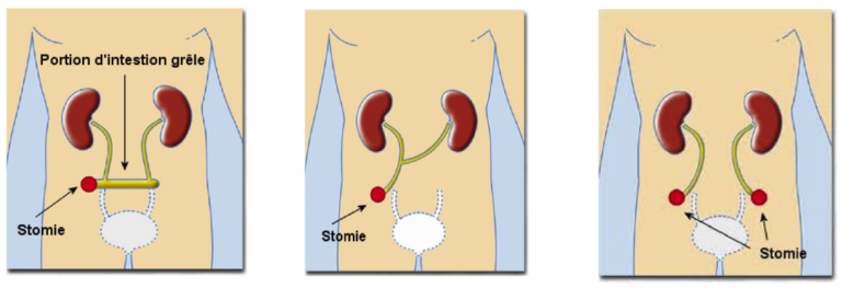 Qu’est-ce qu’une stomie urinaire ? | URILCO 33
